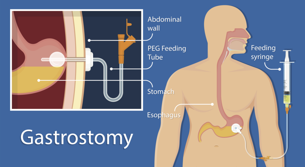 Feeding Tube Surgery – Sheldon's ALS Journey
